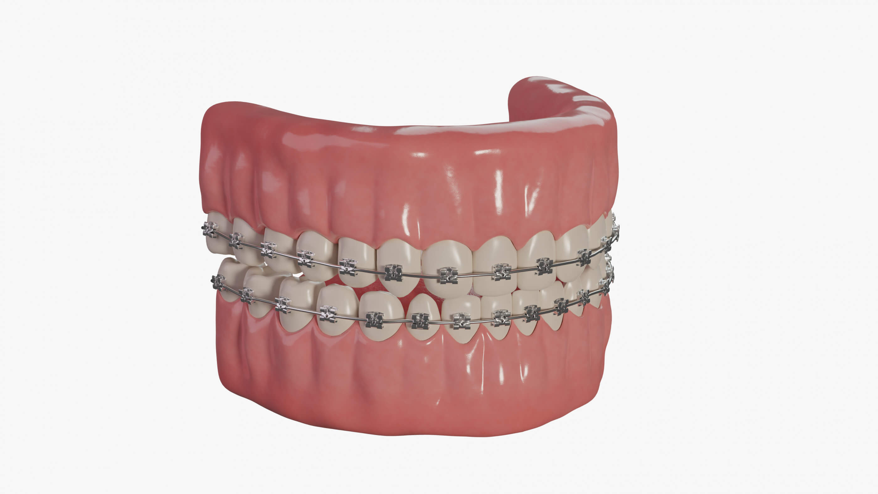 Teeth With Self-Legating Braces 3D Model by esfey
