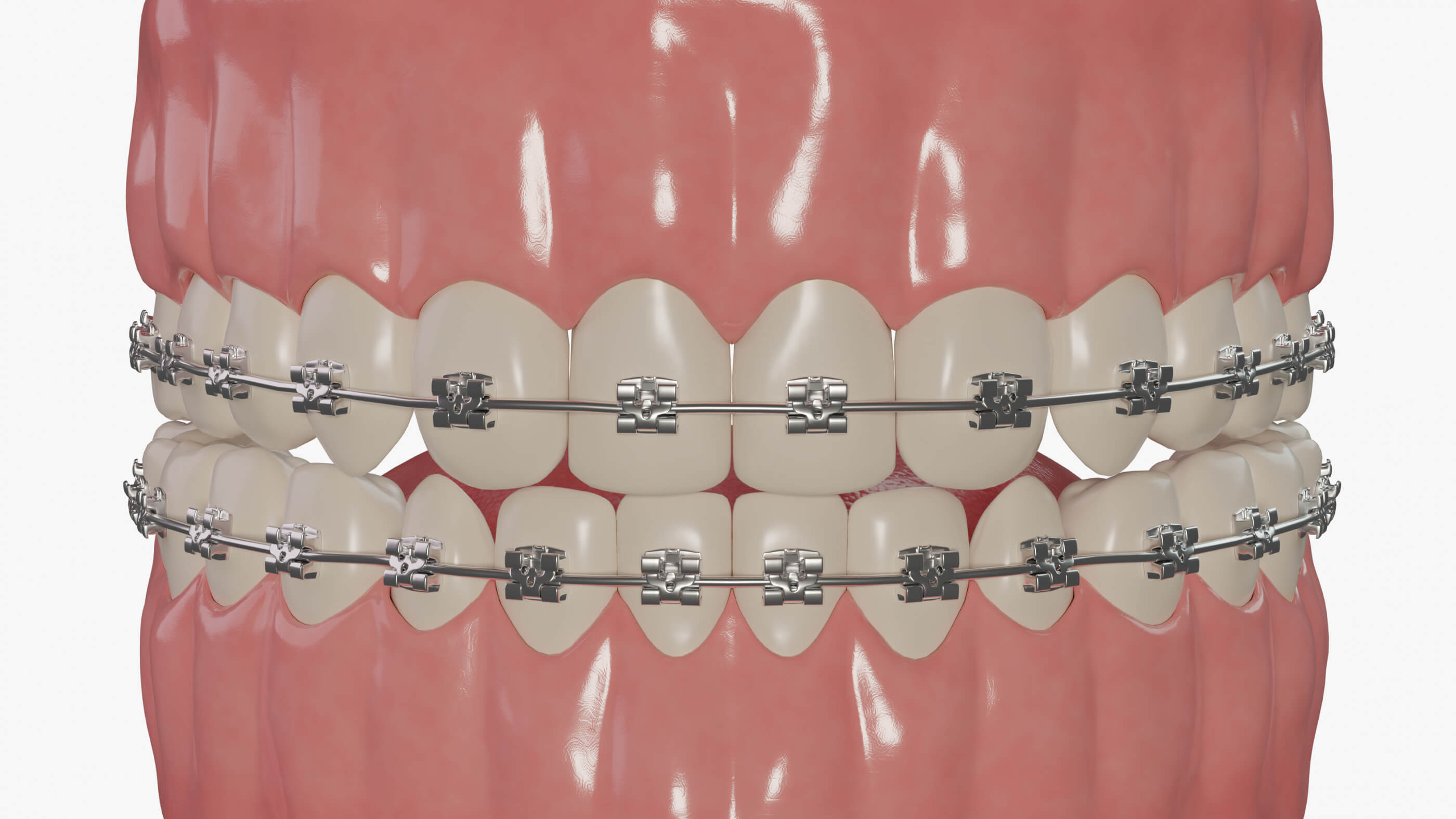 Silver Braces For Teeth