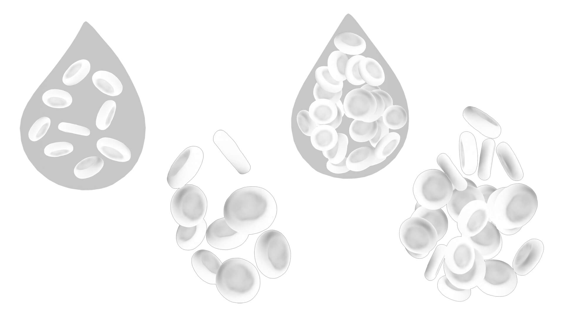 Normal Blood Cells Vs Anemia - 3D Model by h3ydari96