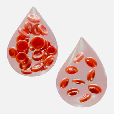 Normal Blood Cells Vs Anemia - 3D Model by h3ydari96