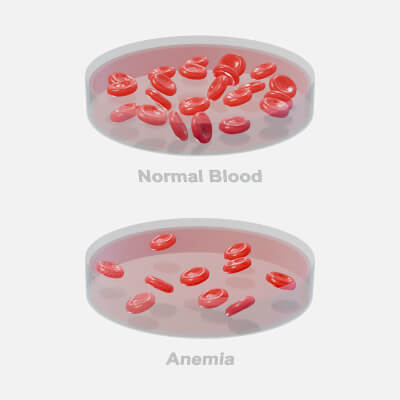 Normal Blood Cells Vs Anemia - 3D Model by h3ydari96