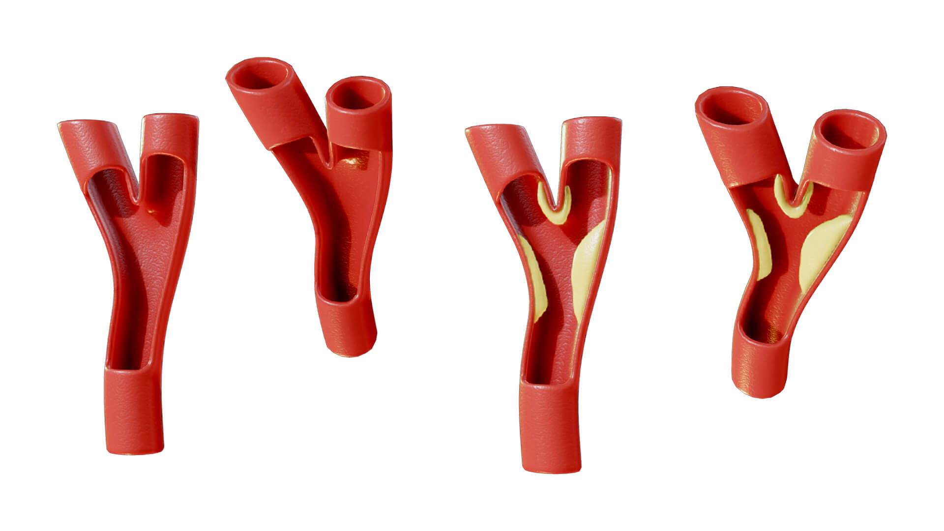 Peripheral Artery Disease - 3D Model by h3ydari96