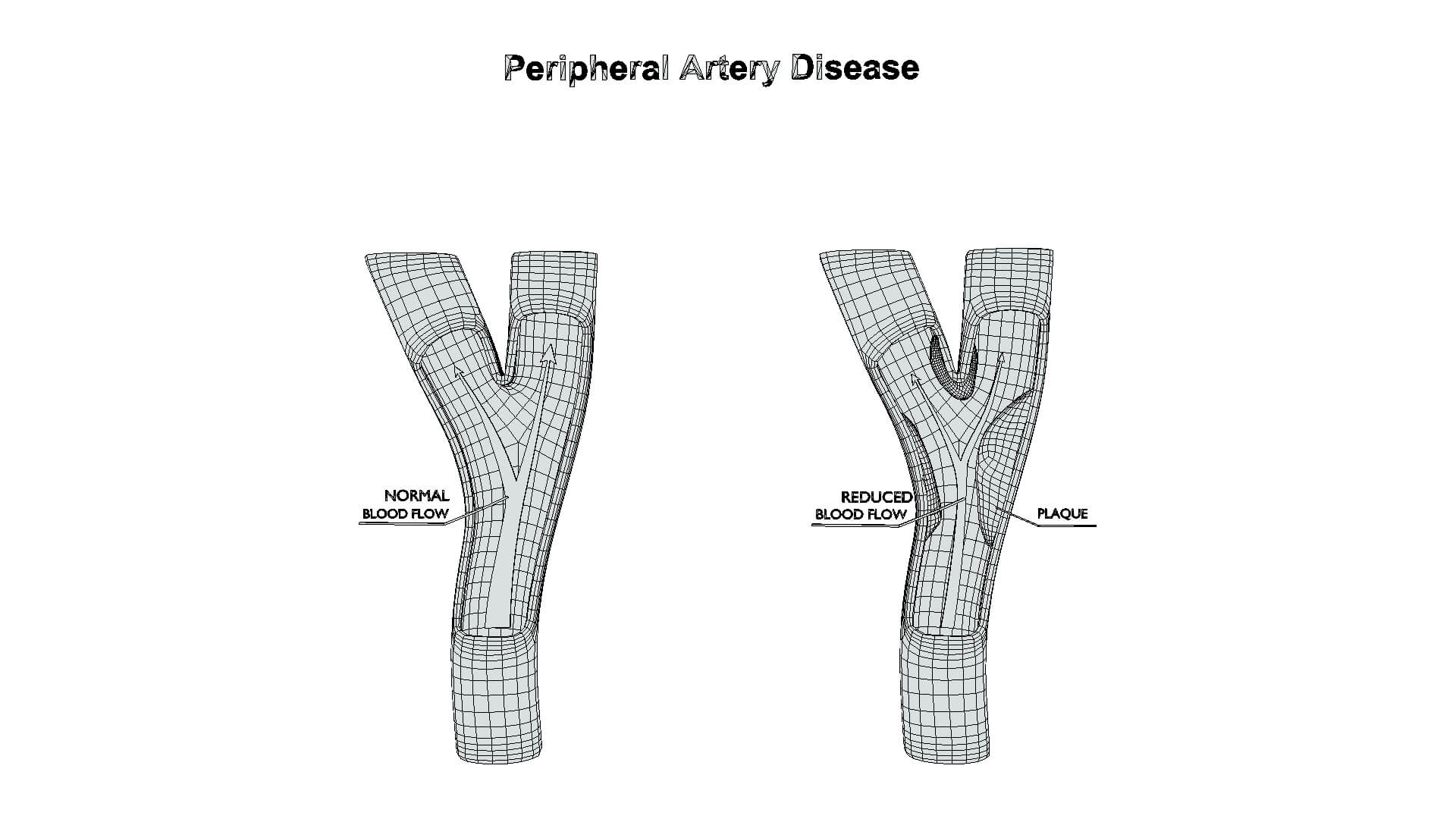 Peripheral Artery Disease - 3D Model by h3ydari96