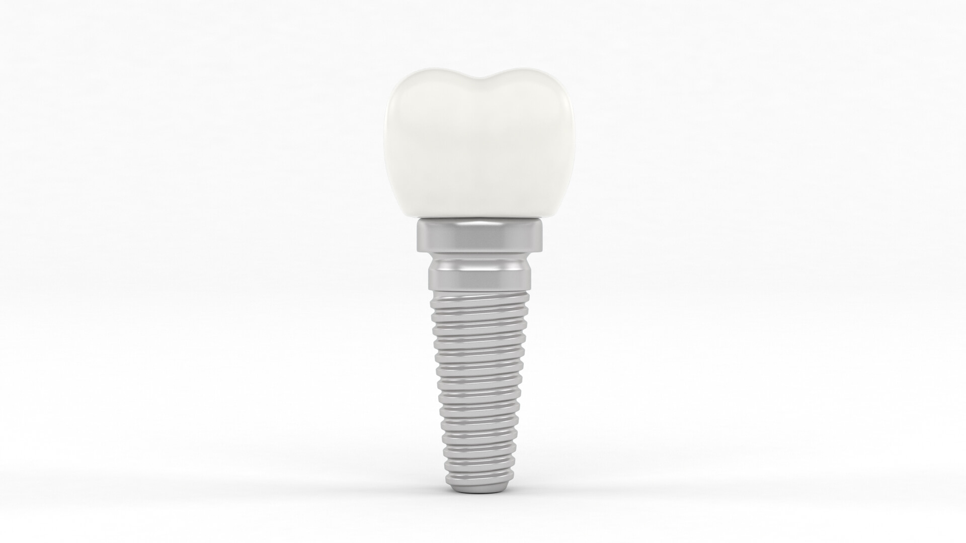 Tooth Implants - 3D Model by Javidan