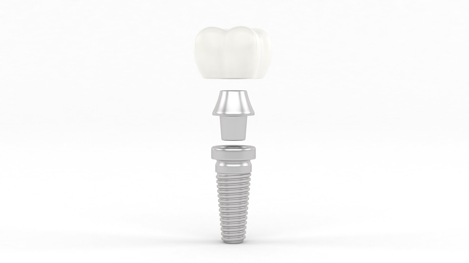 Tooth Implants - 3D Model by Javidan