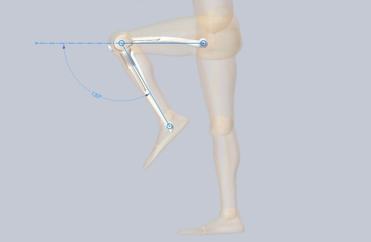 Knee Tumor Prosthesis - 3D Model by Pictorer