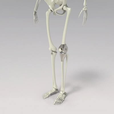 Knee Tumor Prosthesis - 3D Model by Pictorer