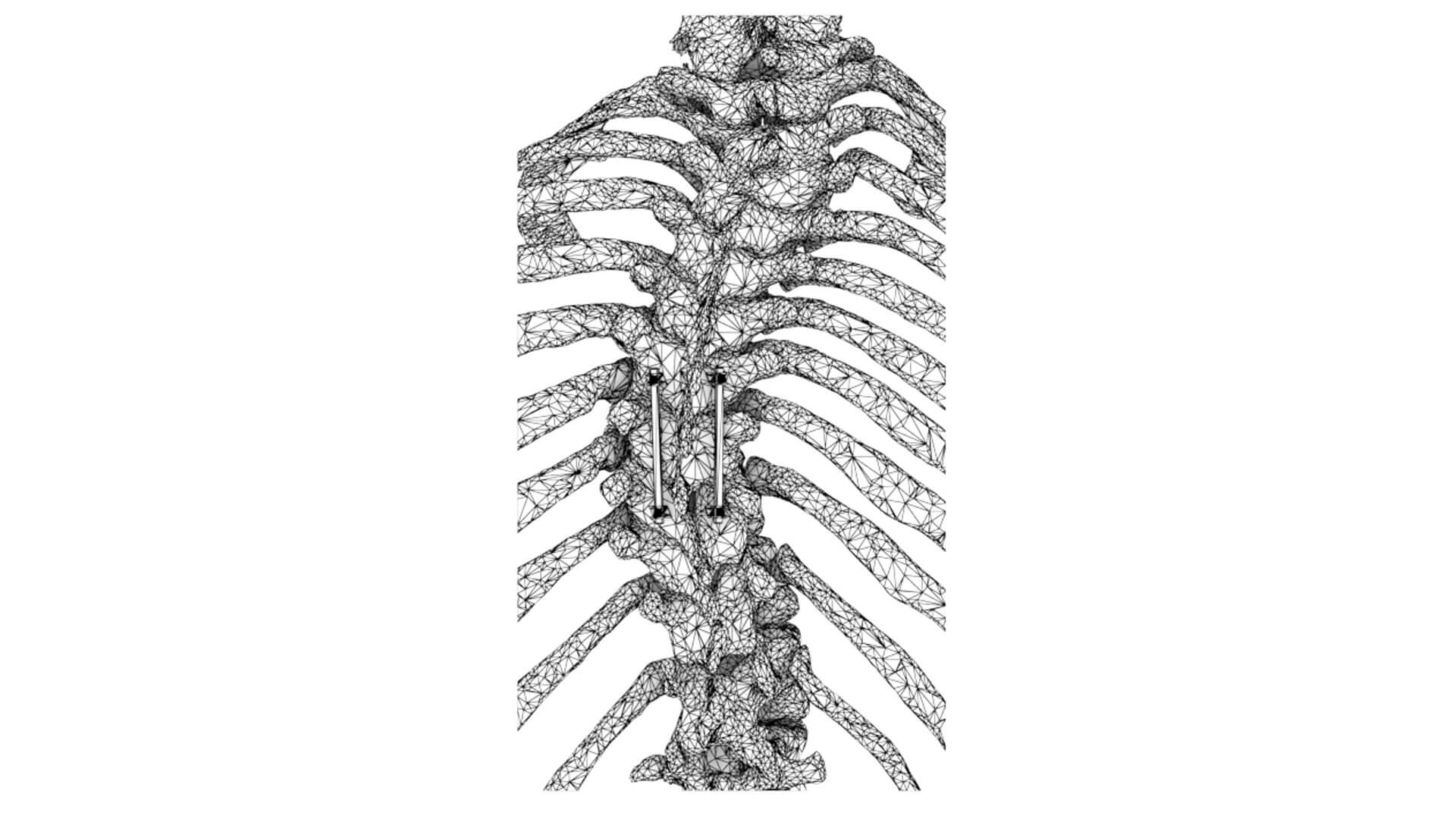 Spine Implant - 3D Model by Pictorer