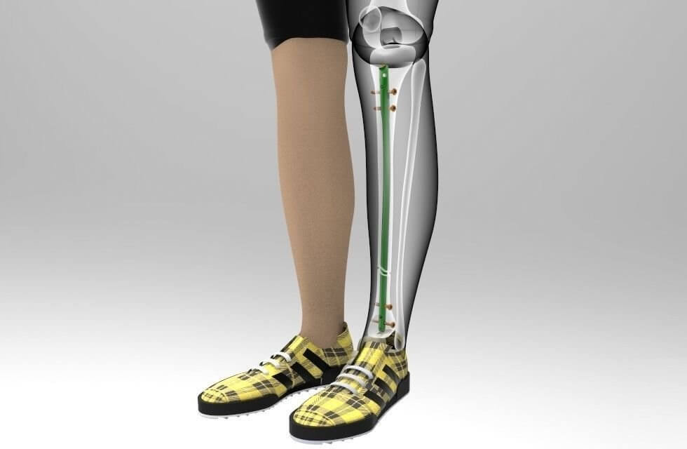 Tibial Intramedullary Nail - 3D Model by Pictorer