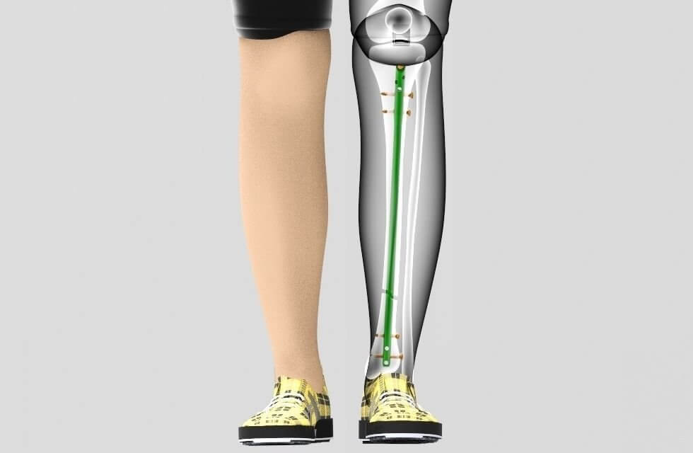 Tibial Intramedullary Nail - 3D Model by Pictorer