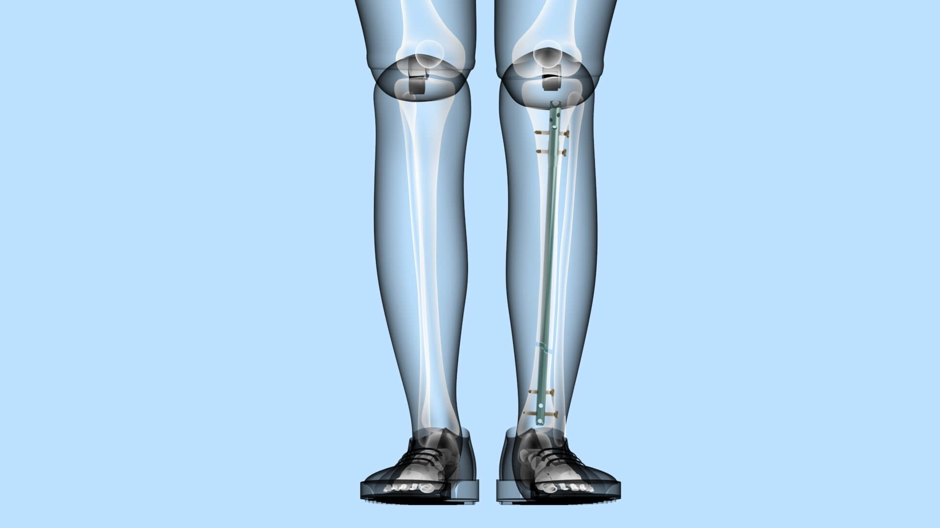 Tibial Intramedullary Nail - 3D Model by Pictorer