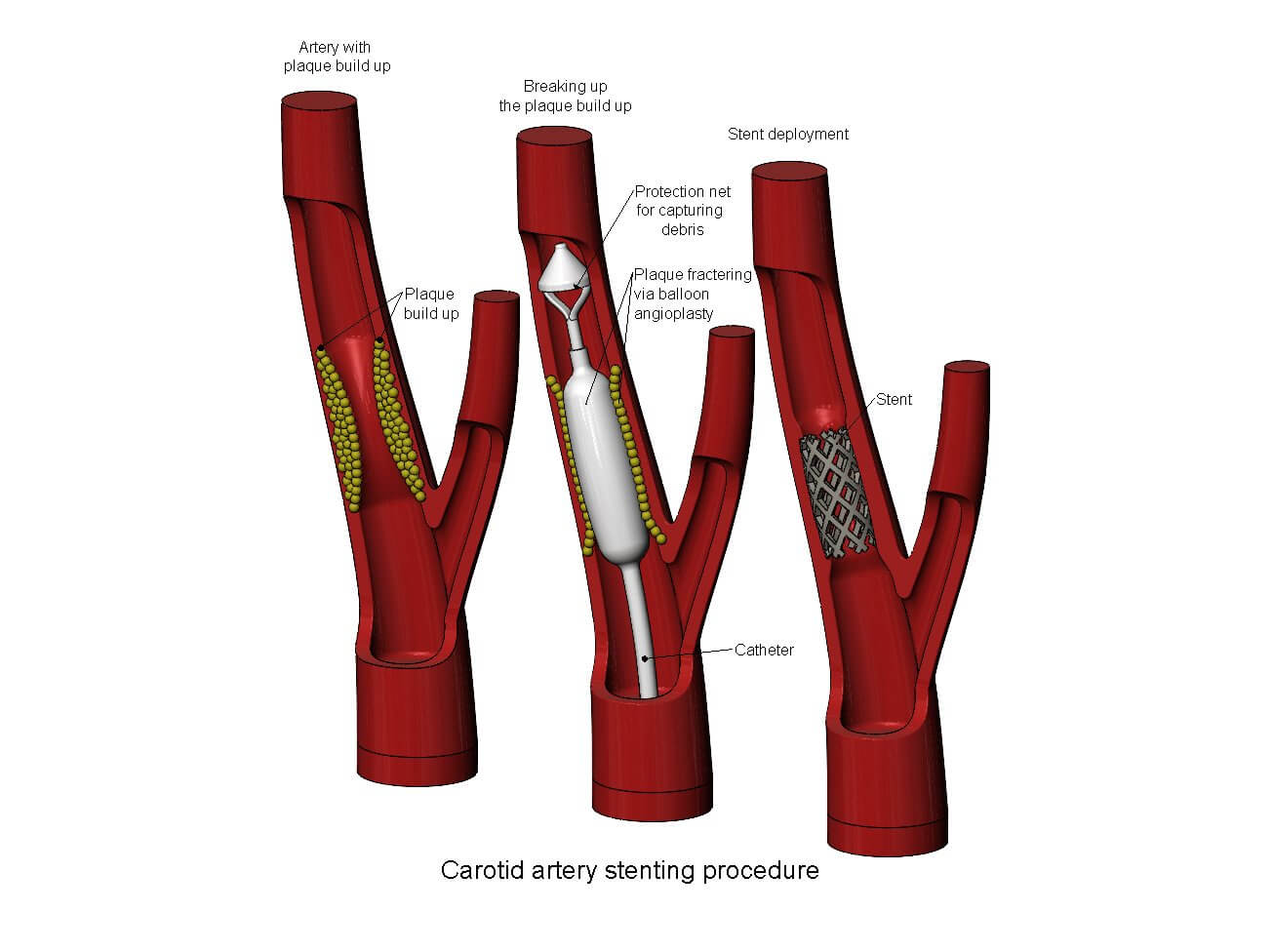 Carotid Artery Stenting Procedure Diorama - 3D Model by RachidSW