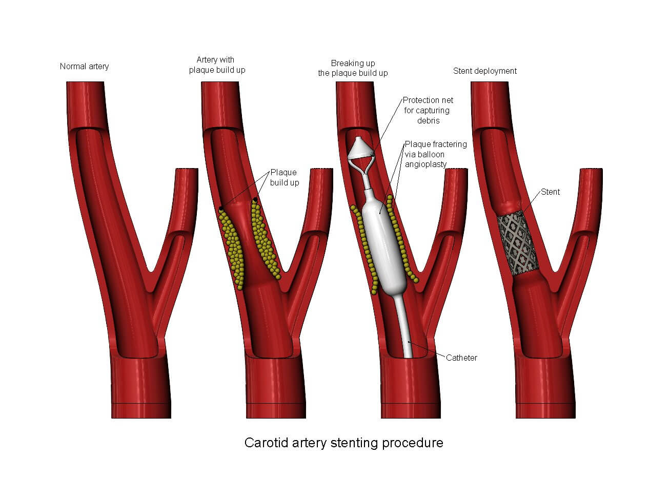 Carotid Artery Stenting Procedure Diorama - 3D Model by RachidSW