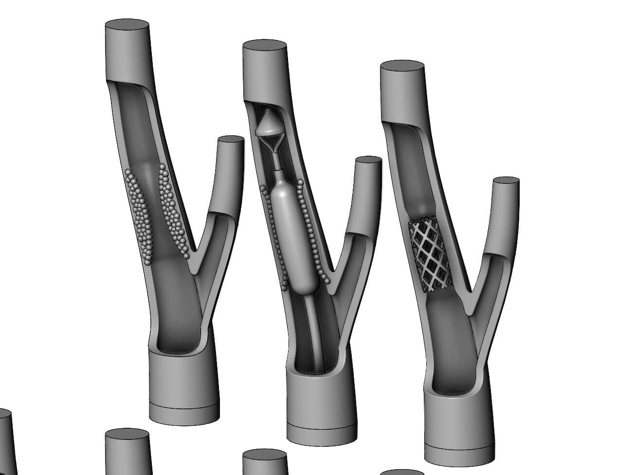 Carotid Artery Stenting Procedure Diorama - 3D Model by RachidSW