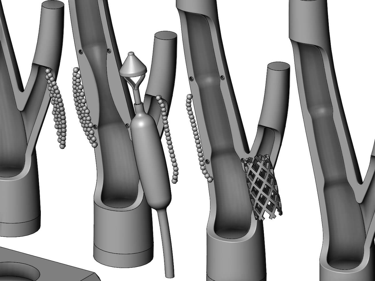 Carotid Artery Stenting Procedure Diorama - 3D Model by RachidSW