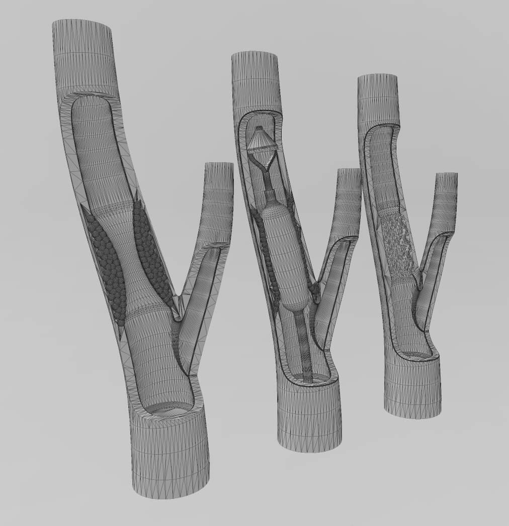 Carotid Artery Stenting Procedure Diorama - 3D Model by RachidSW