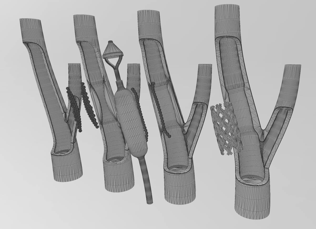 Carotid Artery Stenting Procedure Diorama - 3D Model by RachidSW