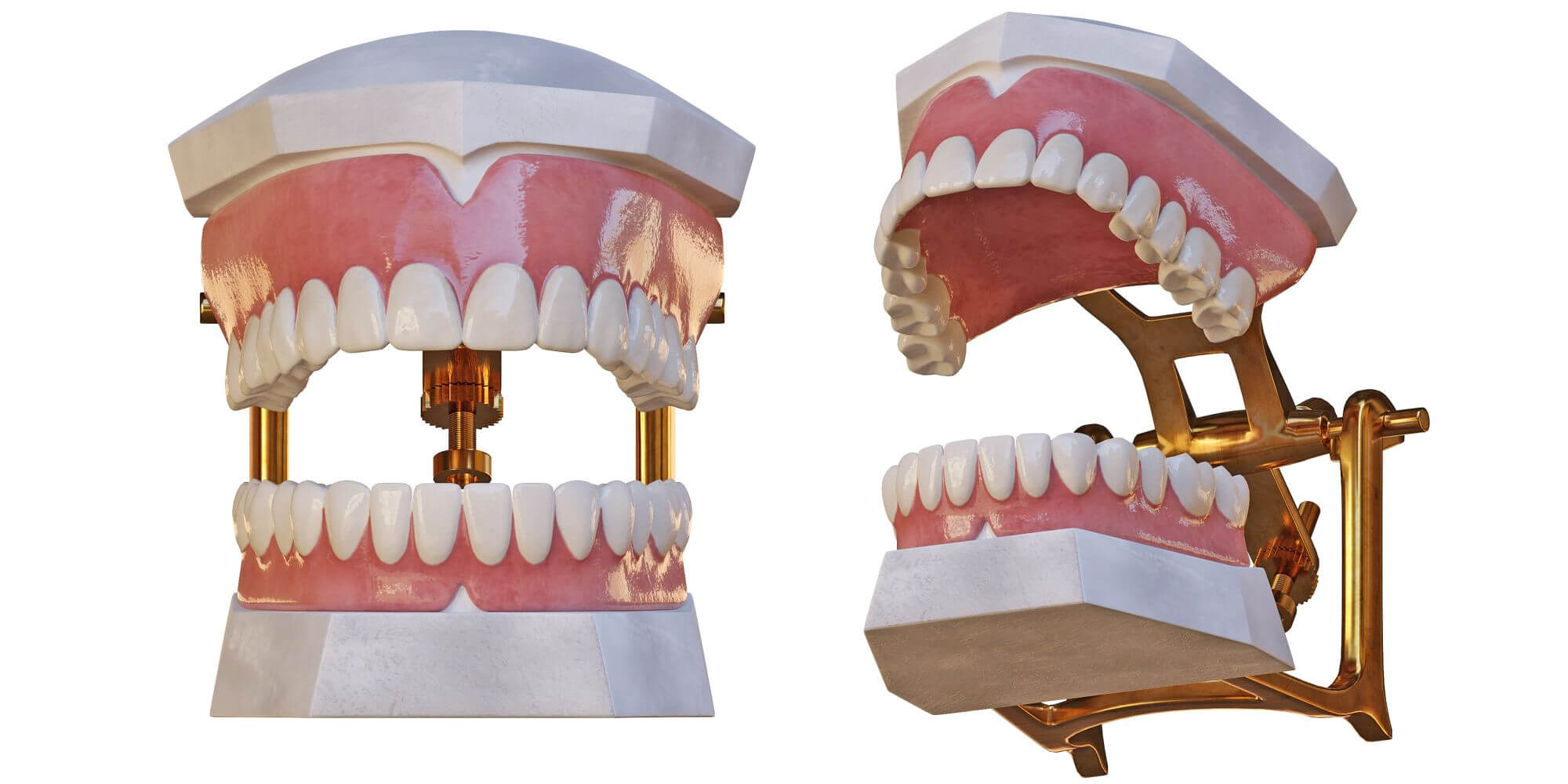 Dental Prosthesis - 3D Model by rossty3d