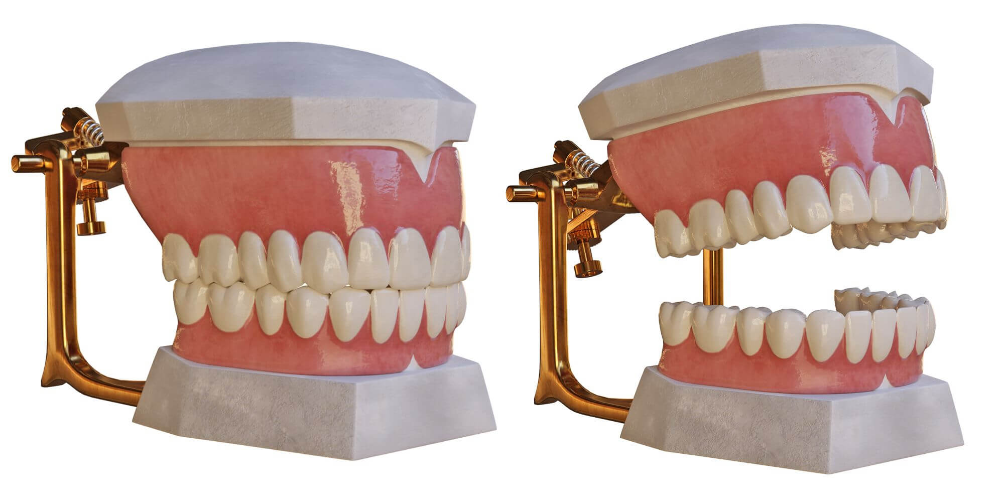 Dental Prosthesis - 3D Model by rossty3d
