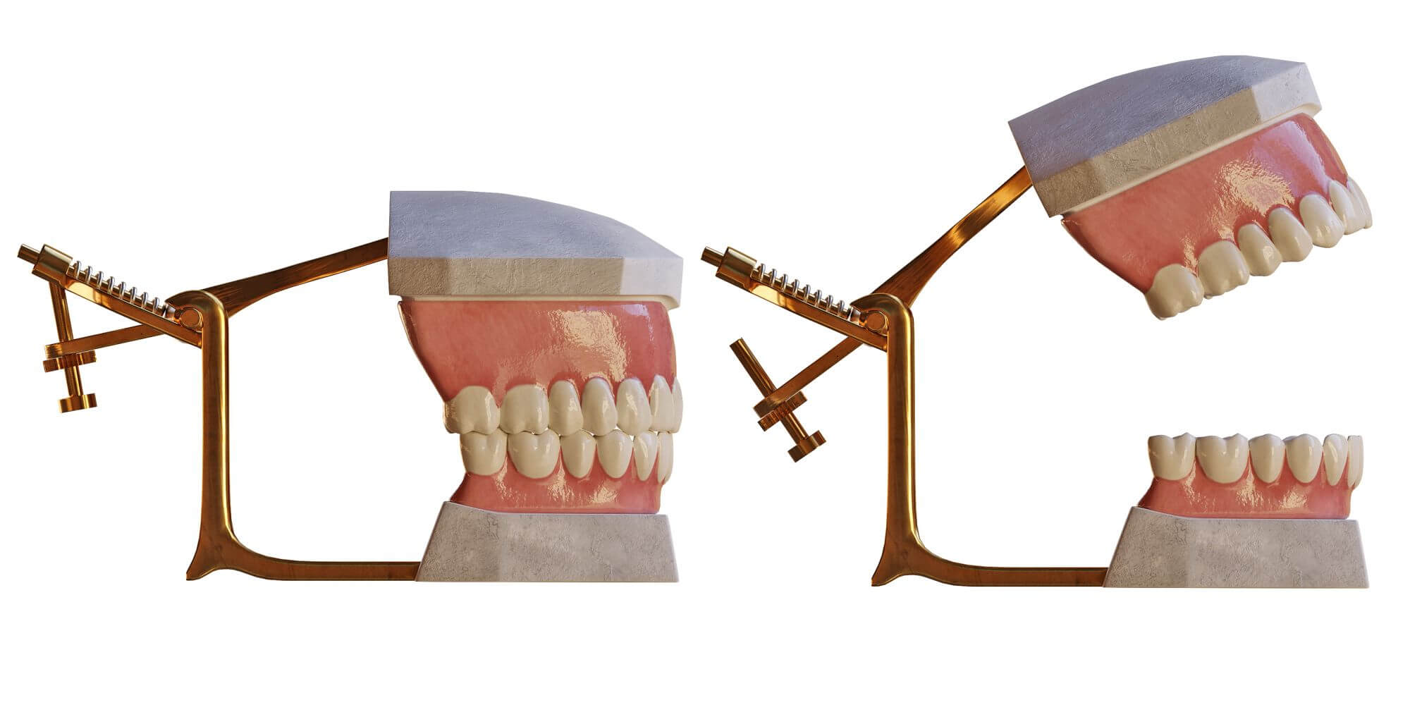 Dental Prosthesis - 3D Model by rossty3d