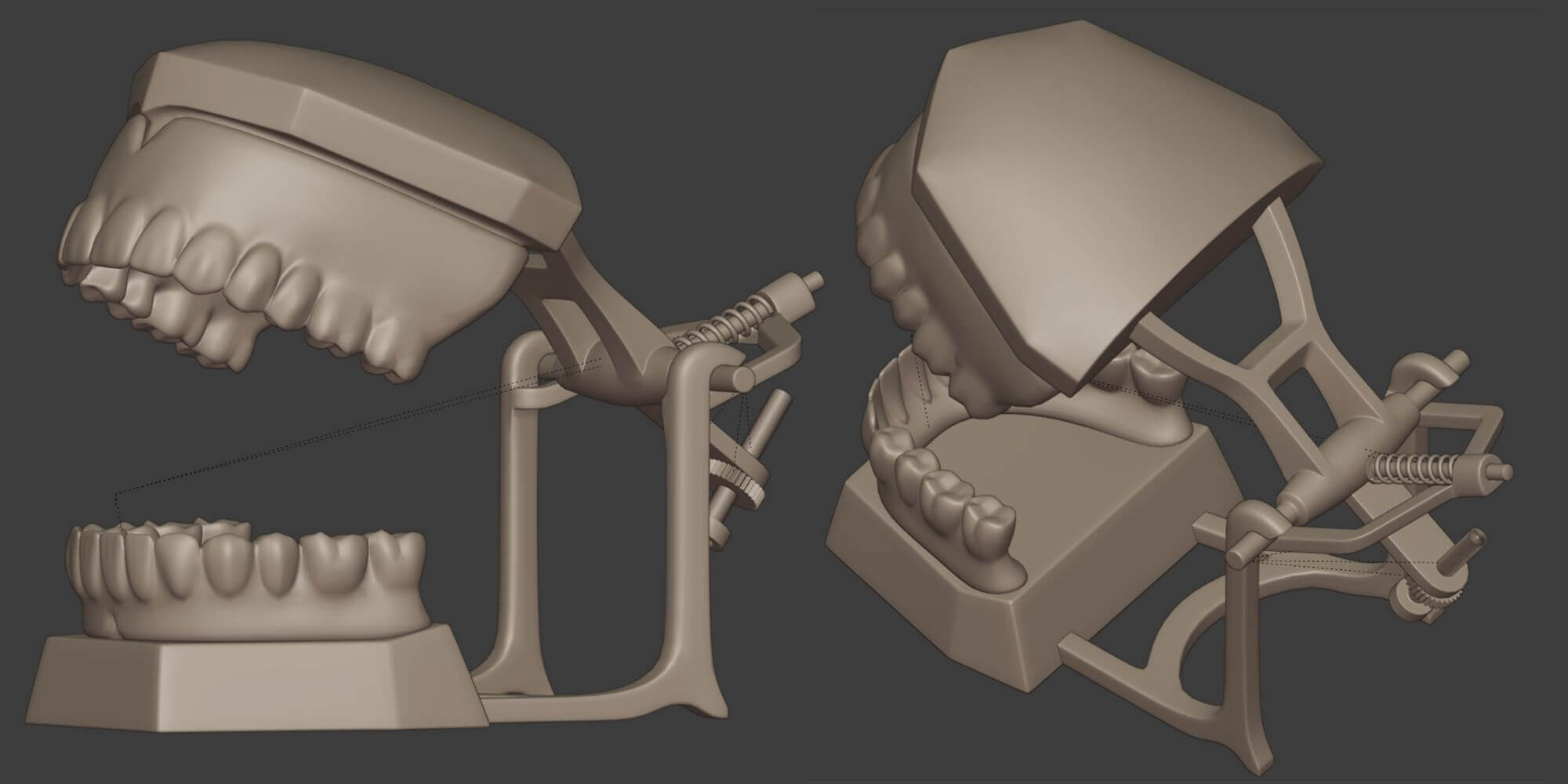 Dental Prosthesis - 3D Model by rossty3d