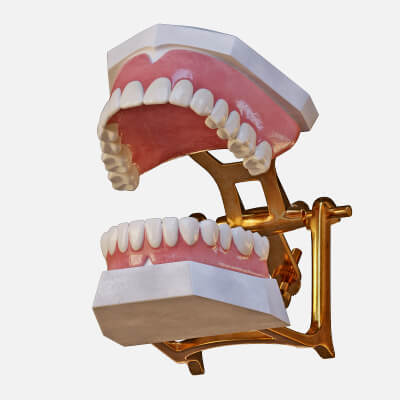 Dental Prosthesis - 3D Model by rossty3d