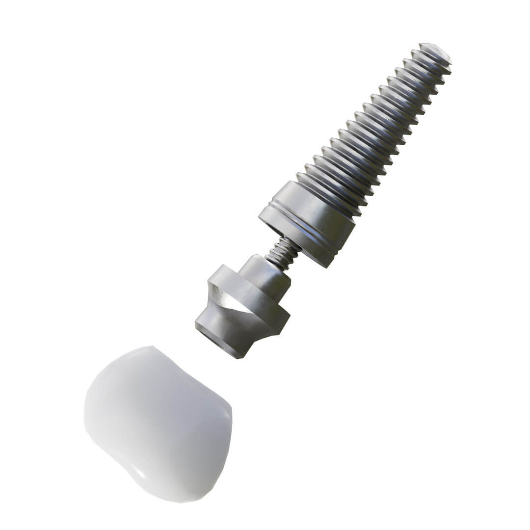 Dental Implant Animation - 3D Model by zames1992d