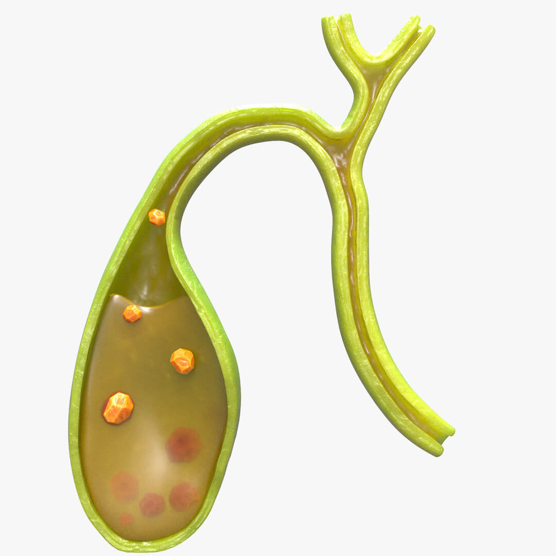Gallbladder With Gallstones - 3D Model by zames1992d