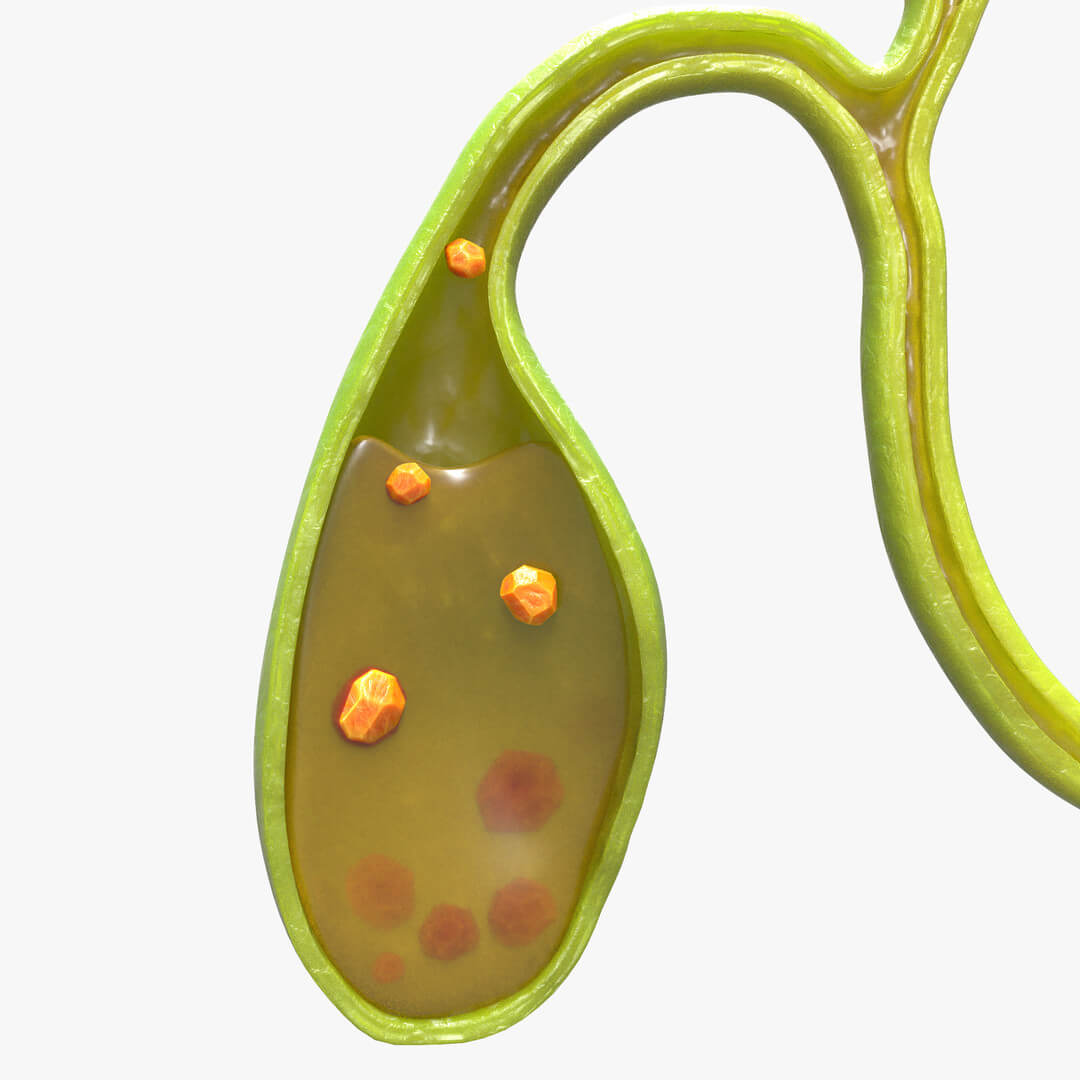 Gallbladder With Gallstones - 3D Model by zames1992d