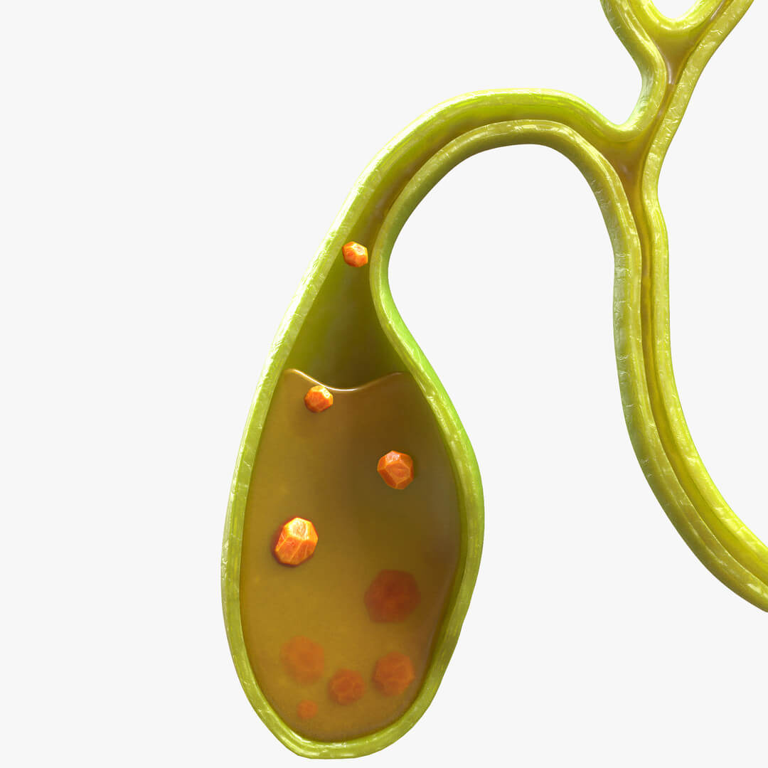Gallbladder With Gallstones - 3D Model by zames1992d