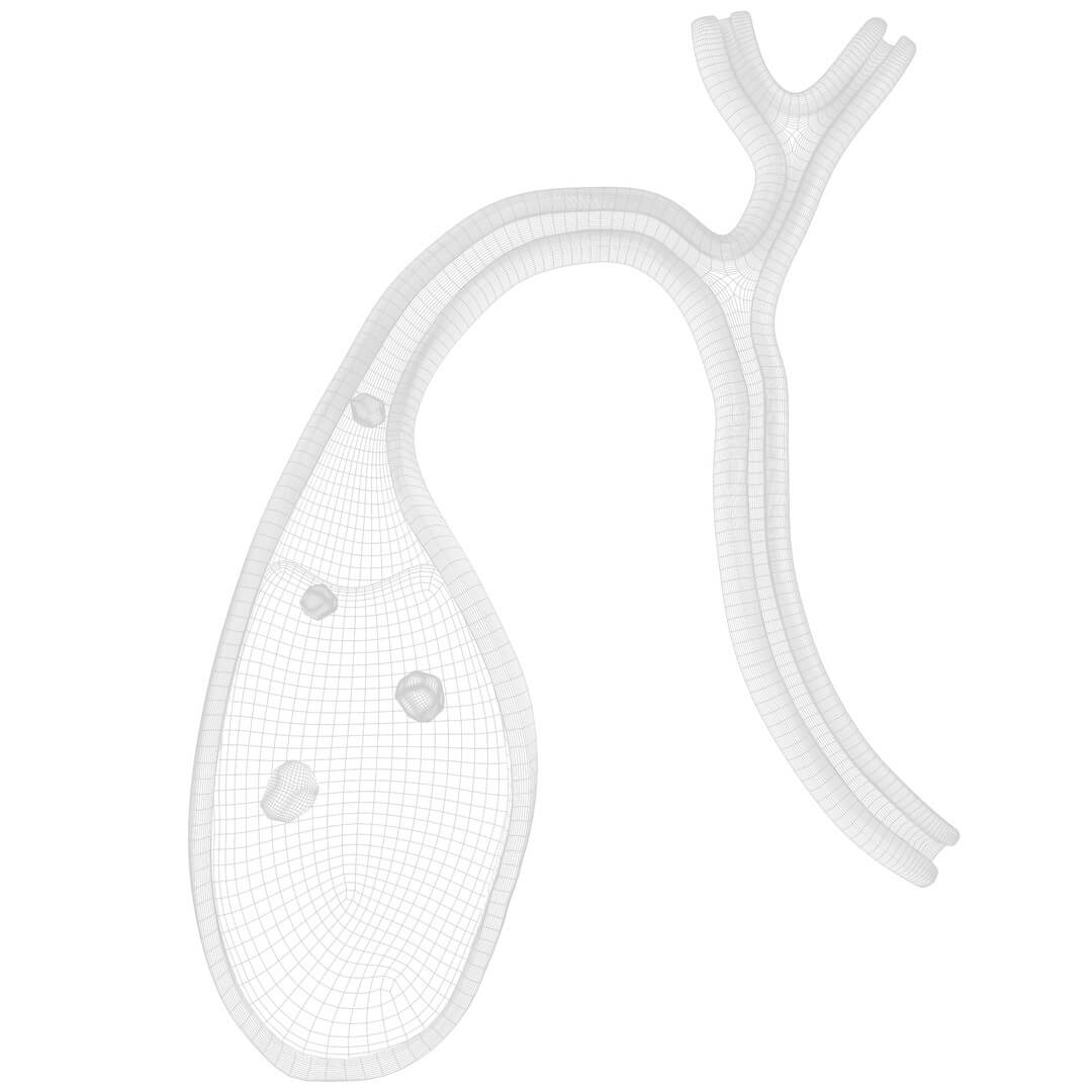 Gallbladder With Gallstones - 3D Model by zames1992d
