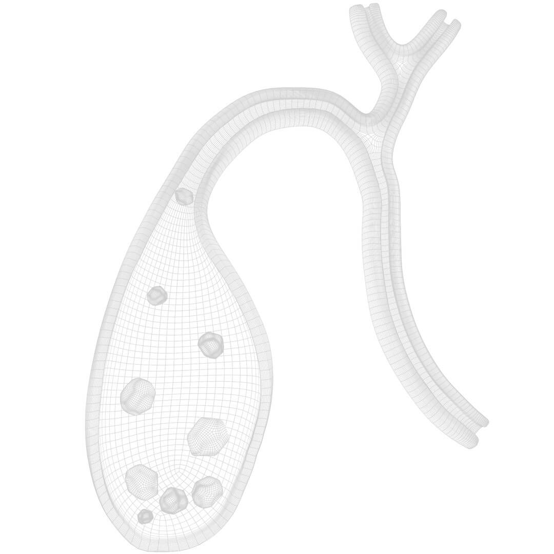 Gallbladder With Gallstones - 3D Model by zames1992d