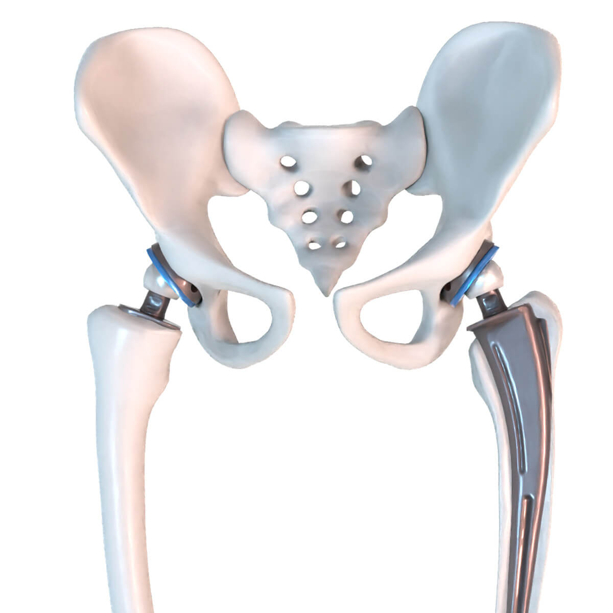 Hip Replacement Implant Installed in The Pelvis Bone - 3D Model by ...
