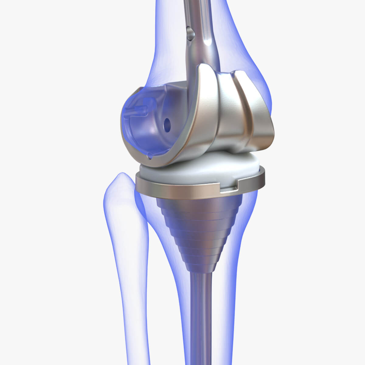 Knee Replacement Implant - 3D Model by zames1992d