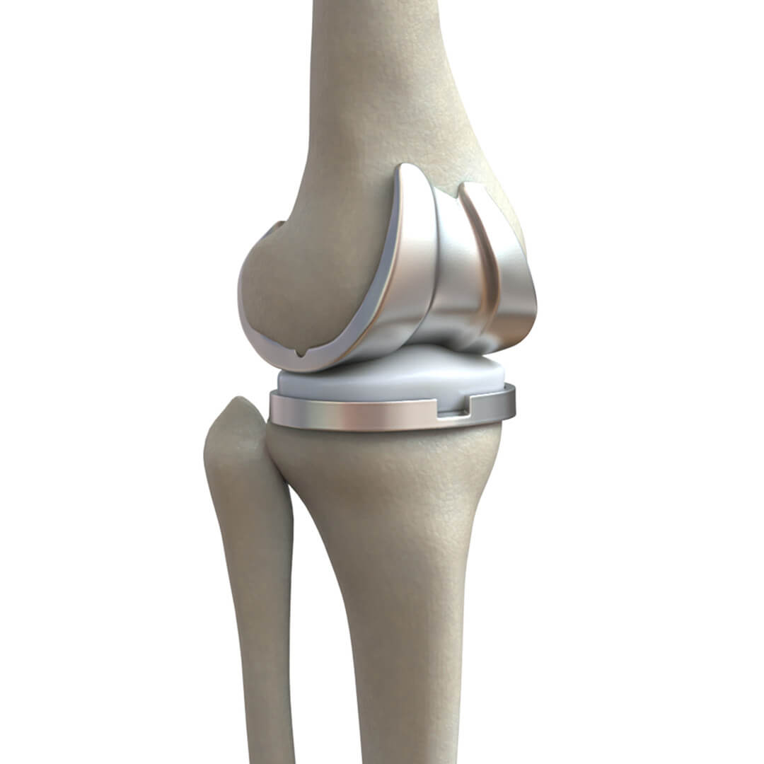 Knee Replacement Implant - 3D Model by zames1992d