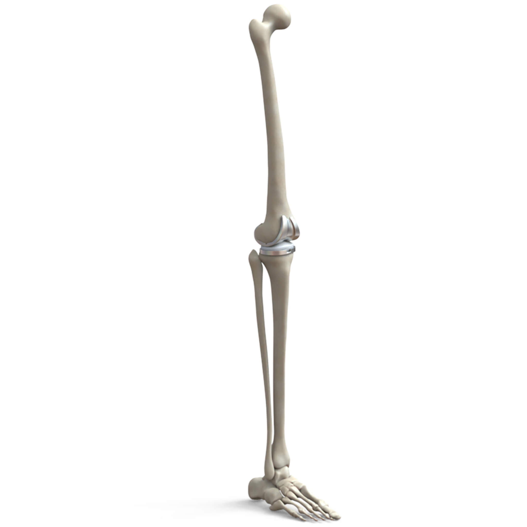 Knee Replacement Implant - 3D Model by zames1992d