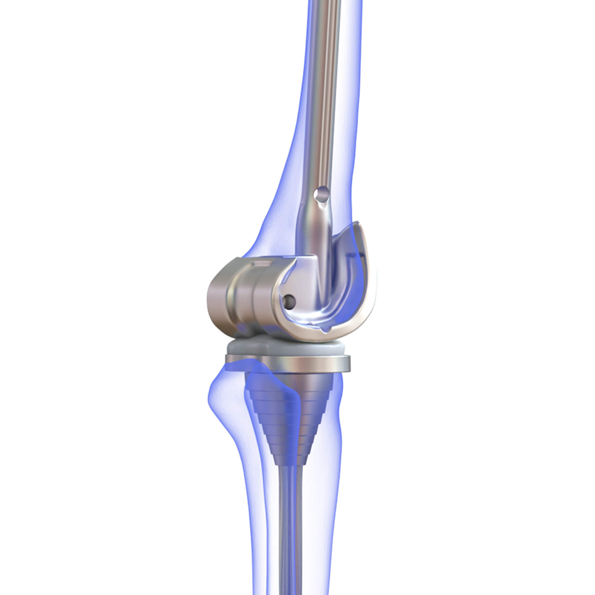 Knee Replacement Implant - 3D Model by zames1992d
