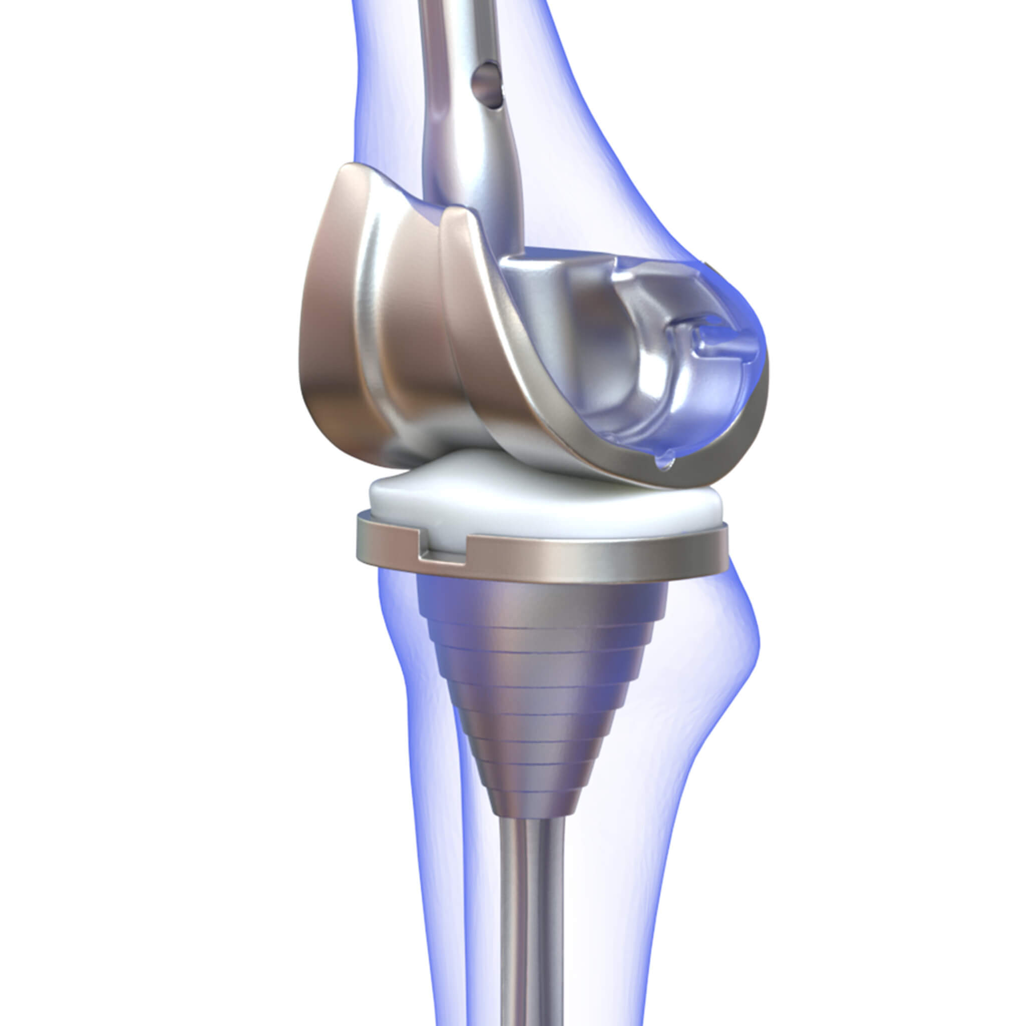 Knee Replacement Implant - 3D Model by zames1992d