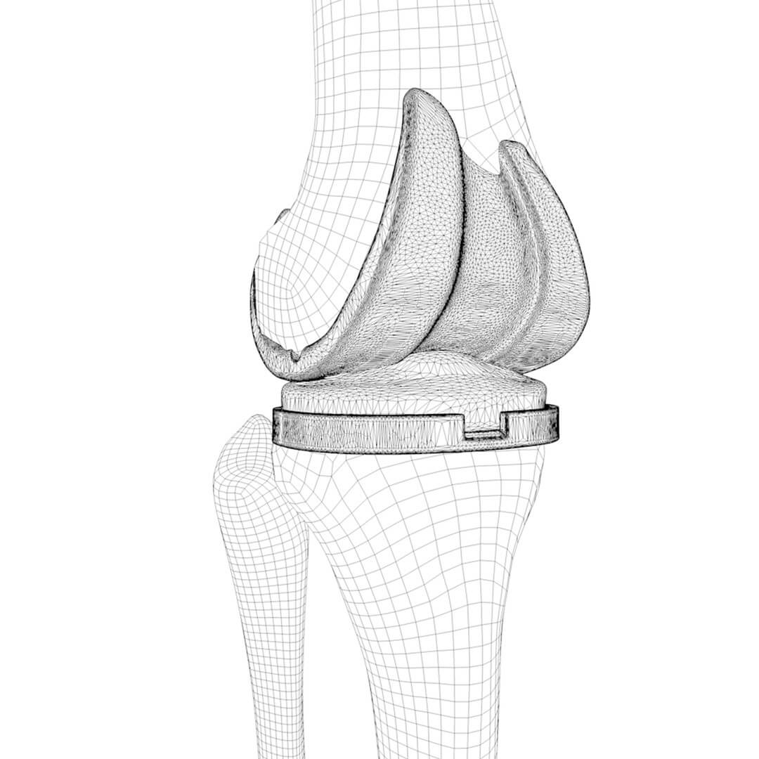 Knee Replacement Implant - 3D Model by zames1992d