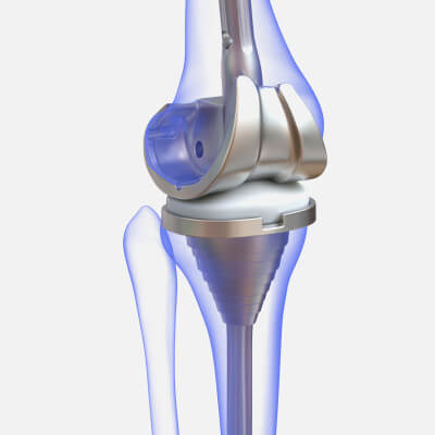 Knee Replacement Implant - 3D Model by zames1992d