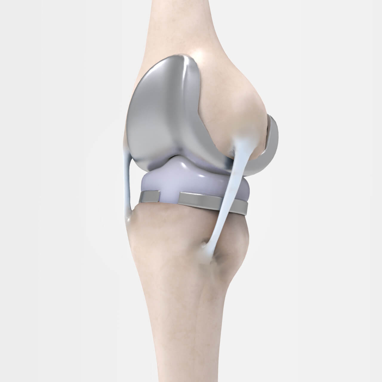 Knee Replacement - 3D Model by zames1992d
