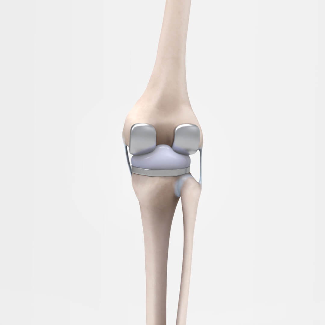 Knee Replacement - 3D Model by zames1992d