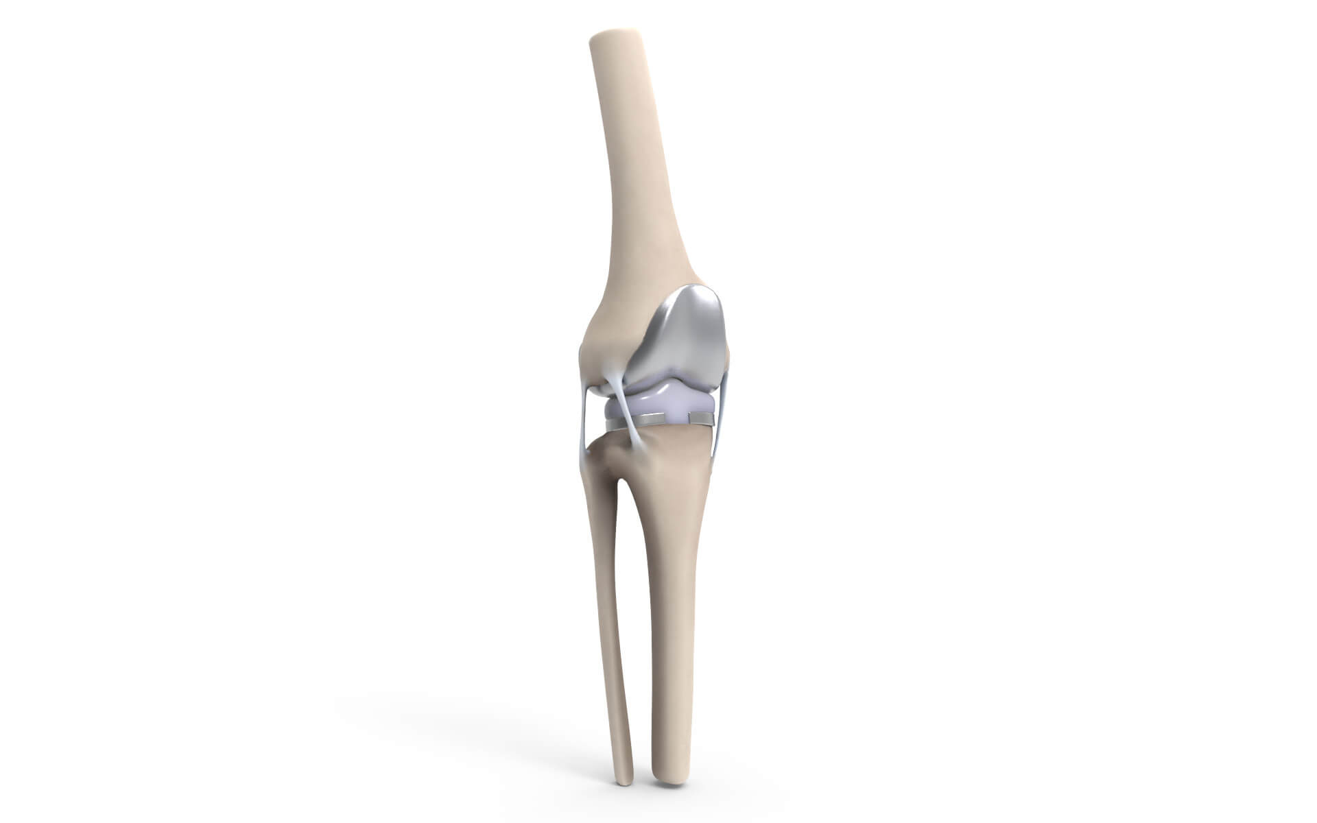 Knee Replacement - 3D Model by zames1992d