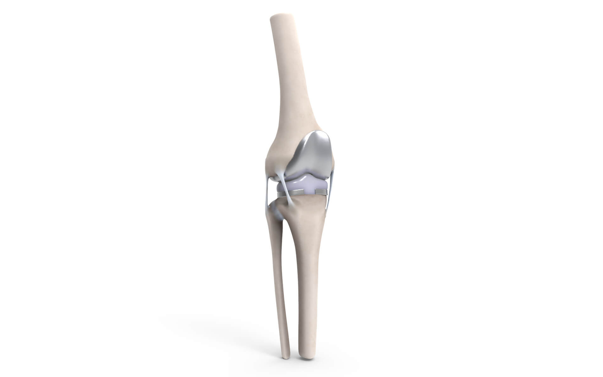 Knee Replacement - 3D Model by zames1992d