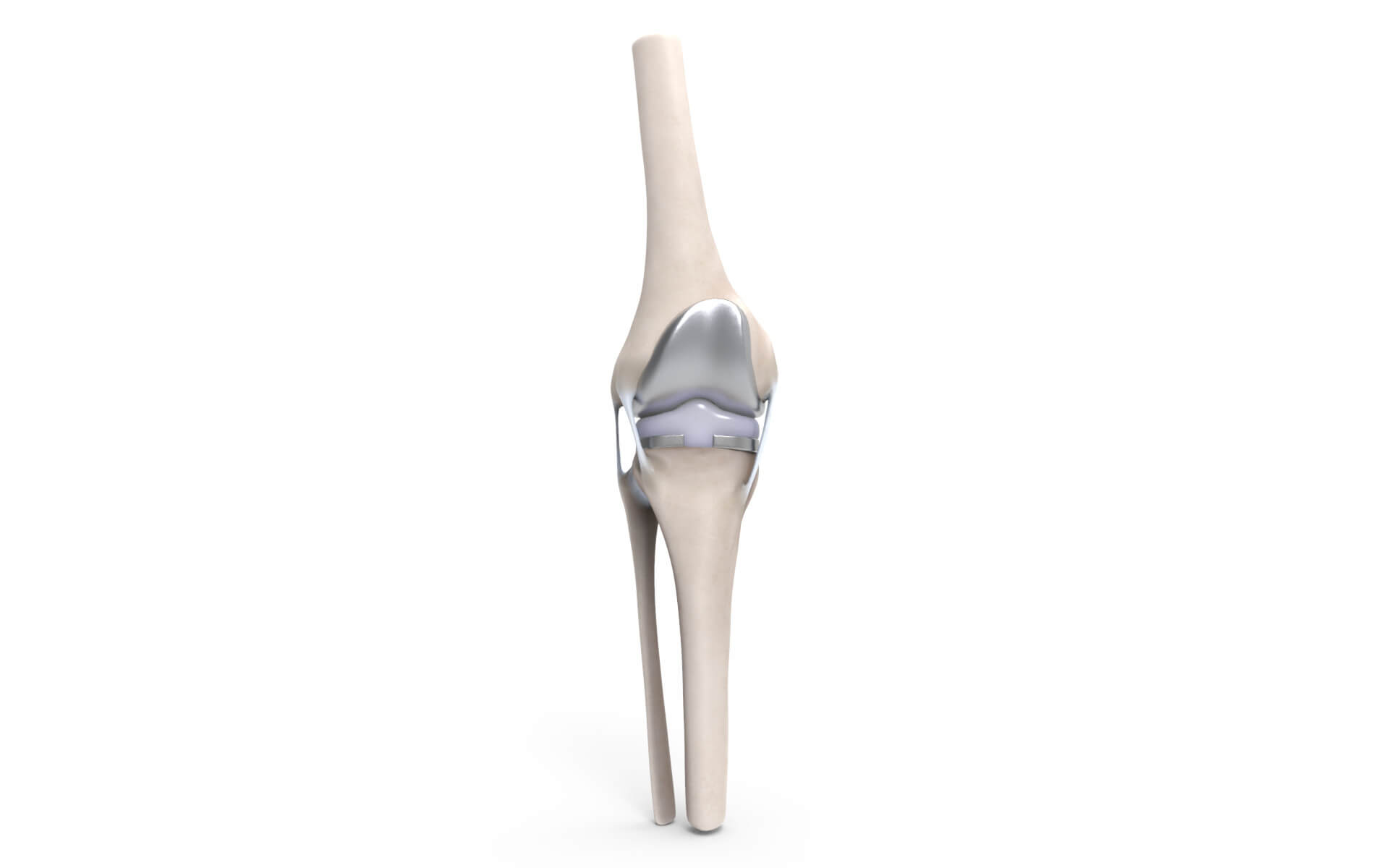 Knee Replacement - 3D Model by zames1992d