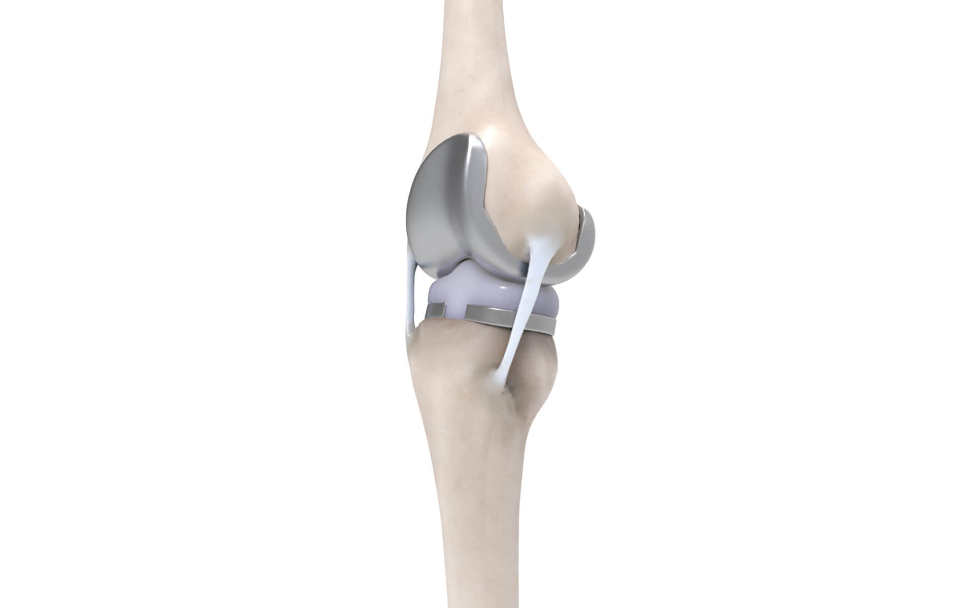Knee Replacement - 3D Model by zames1992d