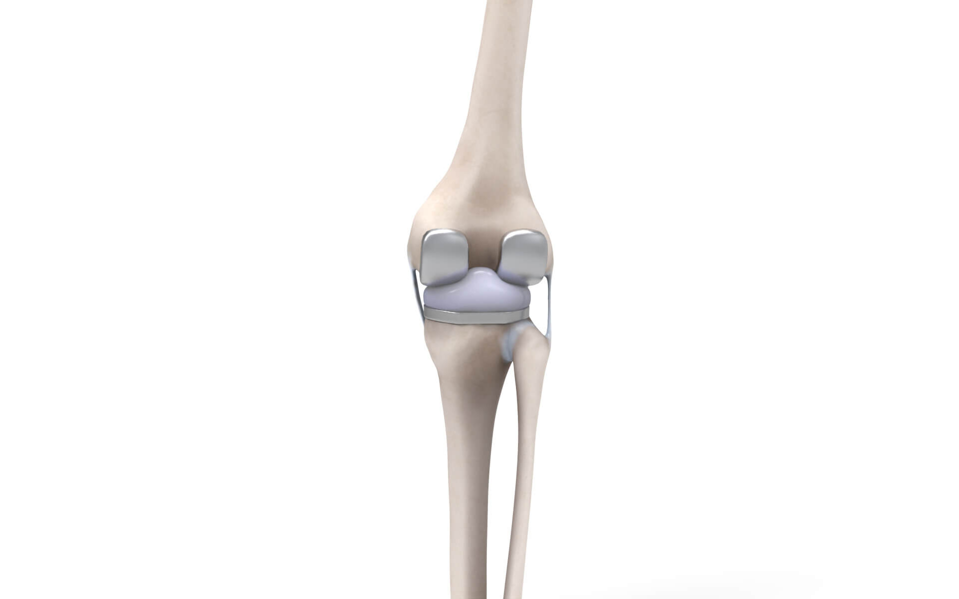 Knee Replacement - 3D Model by zames1992d