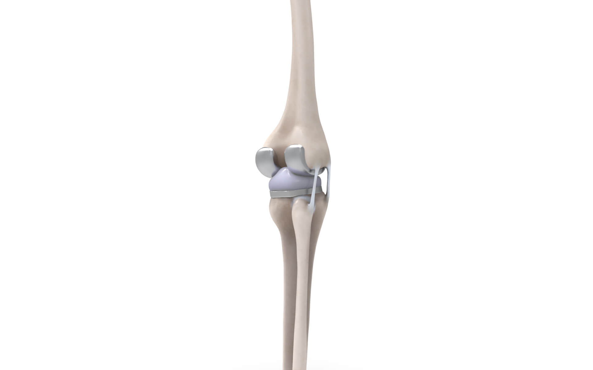 Knee Replacement - 3D Model by zames1992d