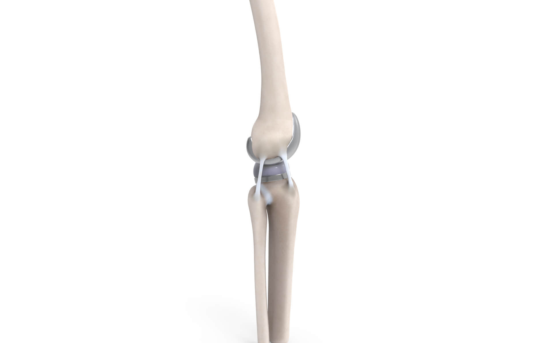Knee Replacement - 3D Model by zames1992d