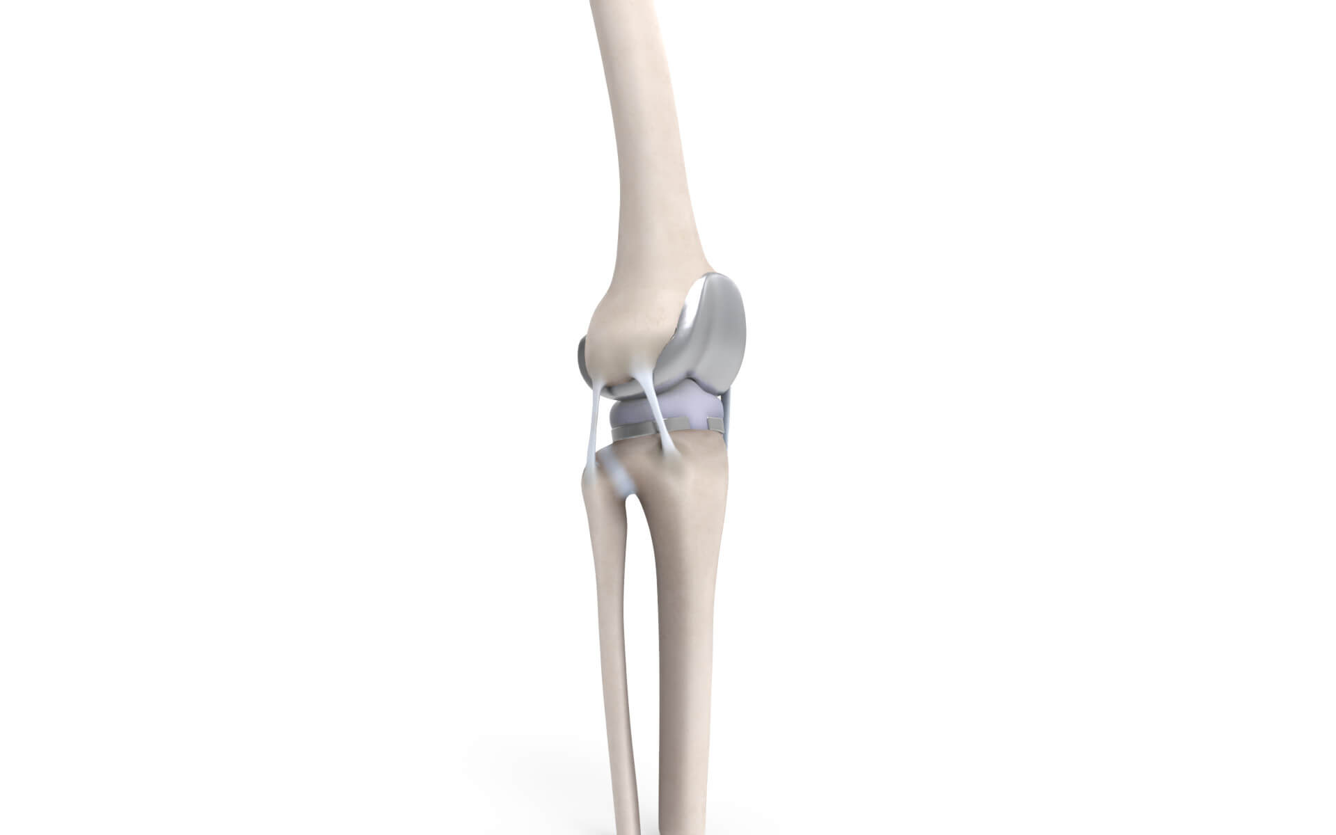 Knee Replacement - 3D Model by zames1992d